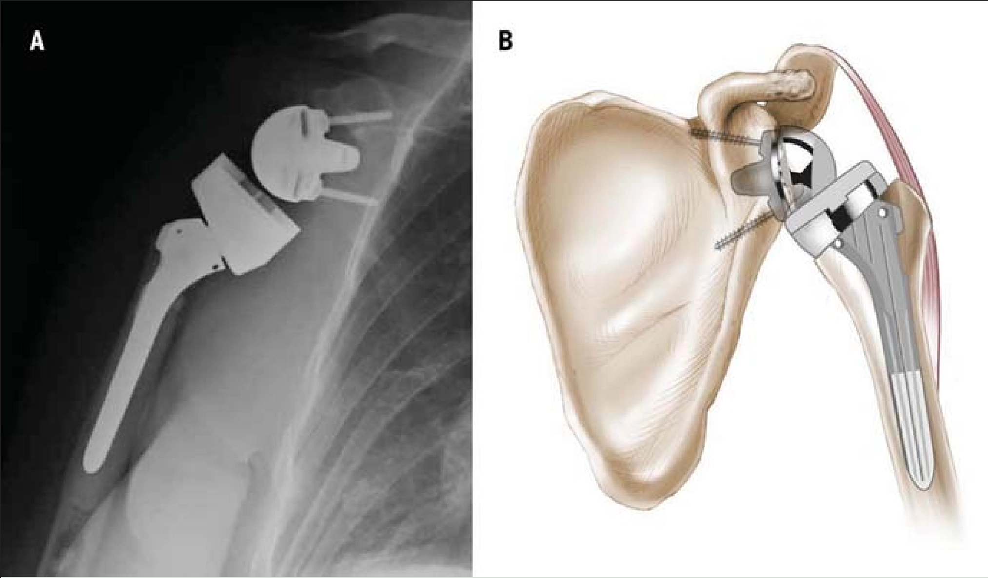 Protesi inversa spalla: riabilitazione - FisioScience