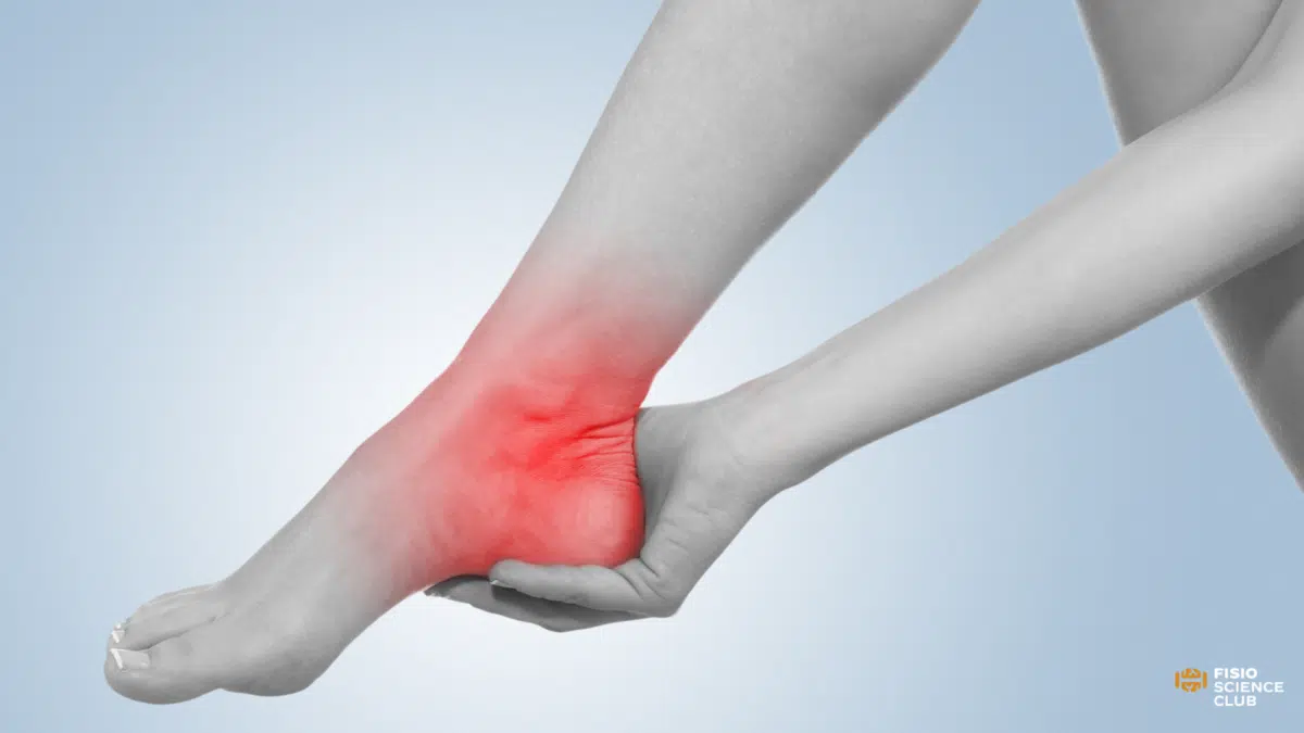 Sindrome del tunnel tarsale - FisioScience