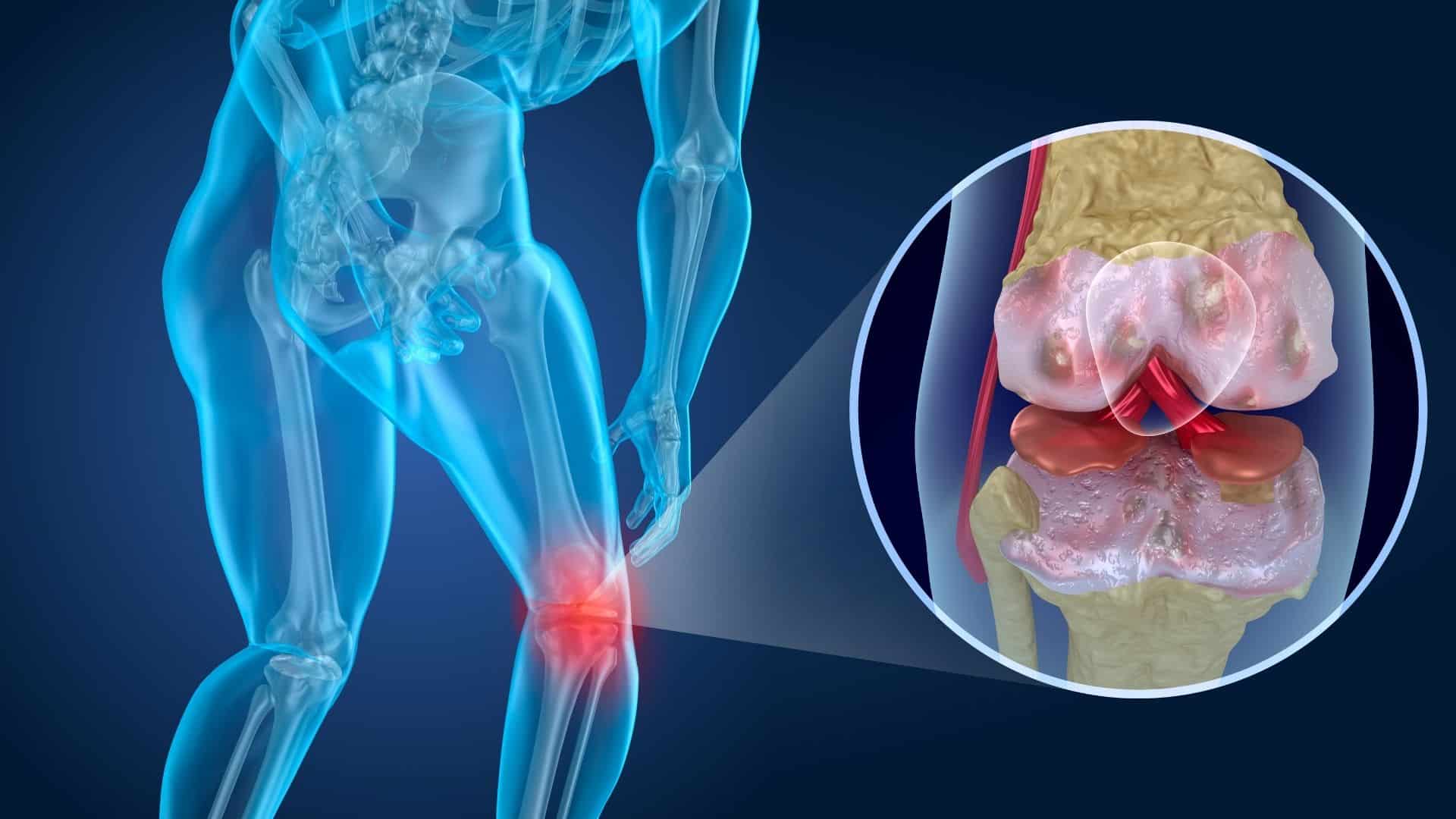 KOOS: Knee injury and Osteoarthritis Outcome Score - FisioScience