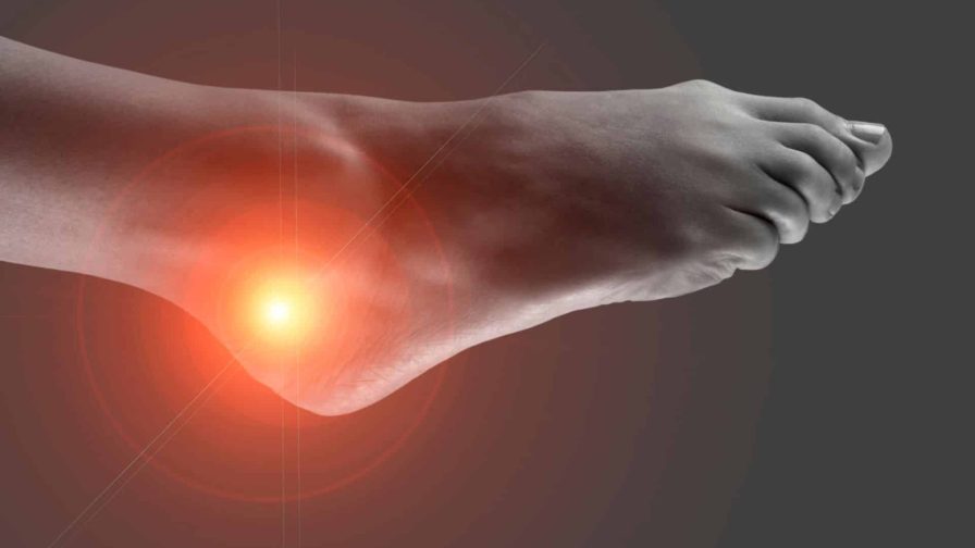 Sindrome del tunnel tarsale - FisioScience