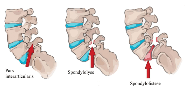Spondilolistesi - FisioScience