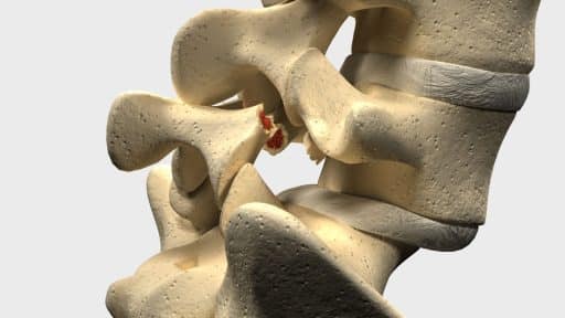 Spondilolistesi - FisioScience