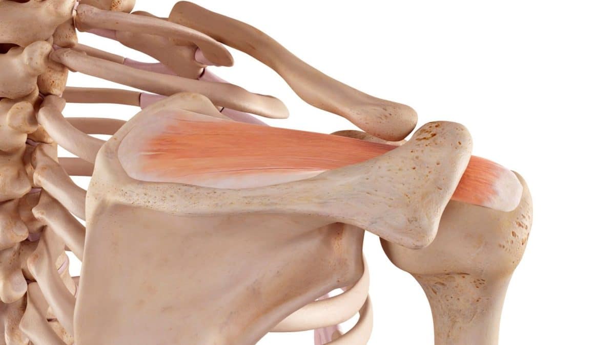 Tendinopatia calcifica di spalla - FisioScience