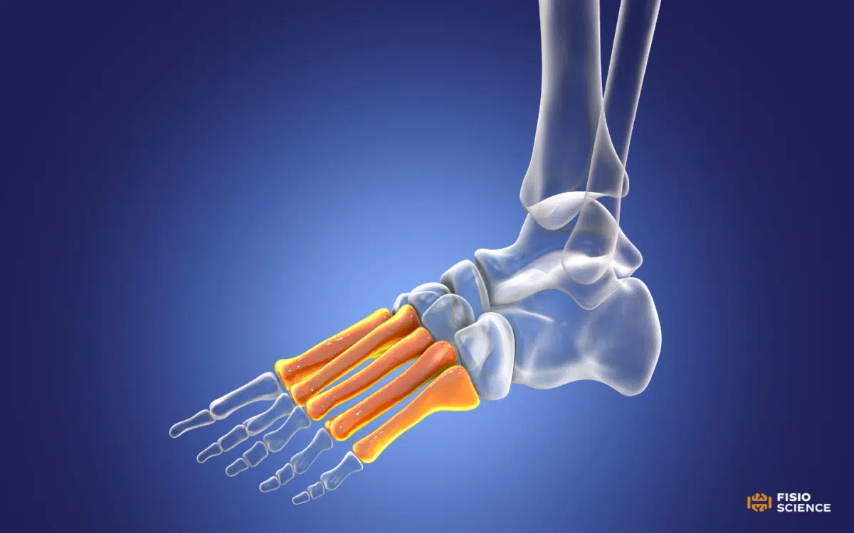 Metatarsalgia - FisioScience