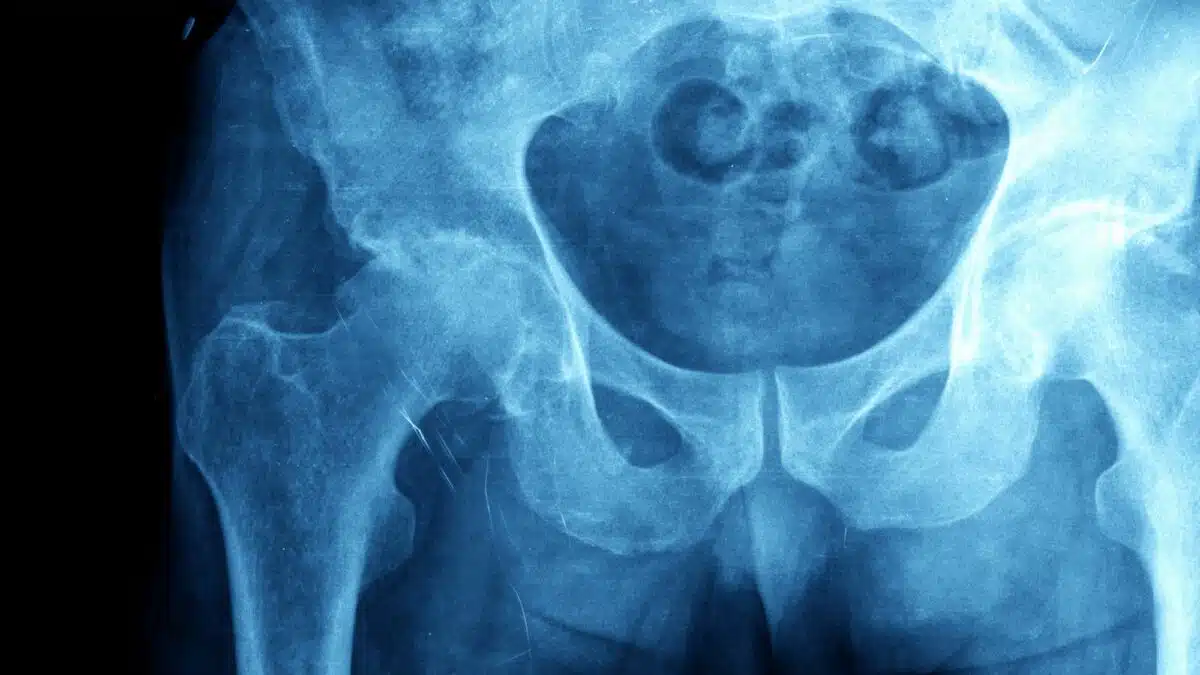Coxartrosi - artrosi dell'anca - FisioScience