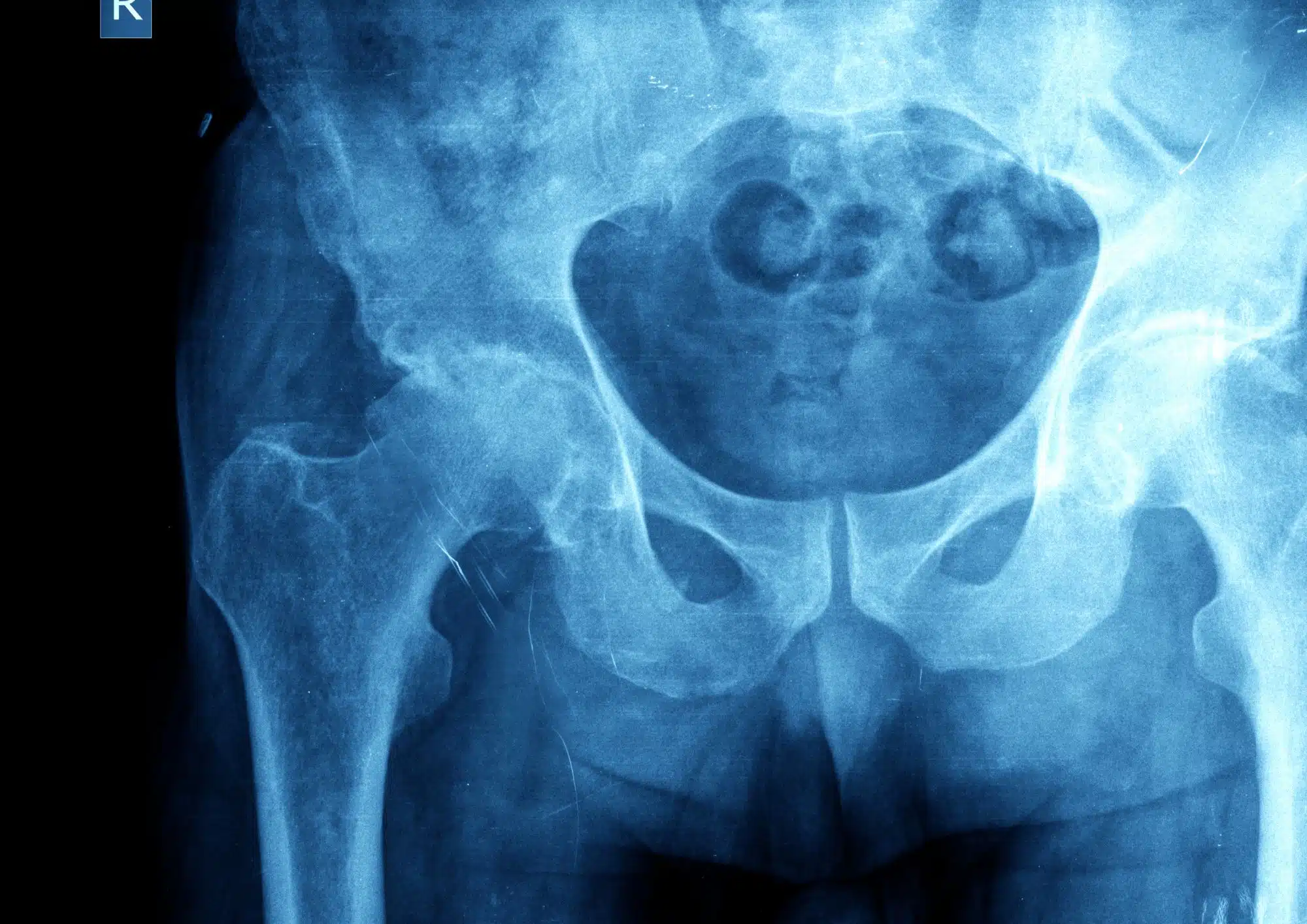 Coxartrosi - artrosi dell'anca - FisioScience