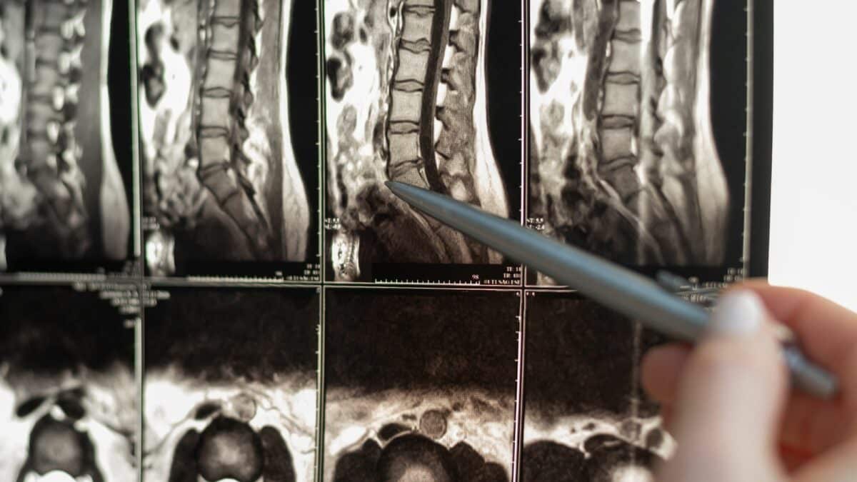 Sindrome della cauda equina - FisioScience