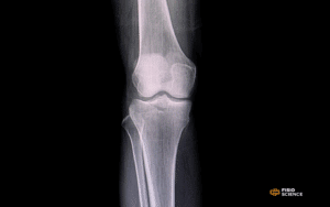 Lesione del legamento collaterale mediale - FisioScience