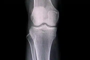 Edema osseo - FisioScience