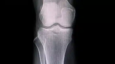 Frattura del piatto tibiale - FisioScience