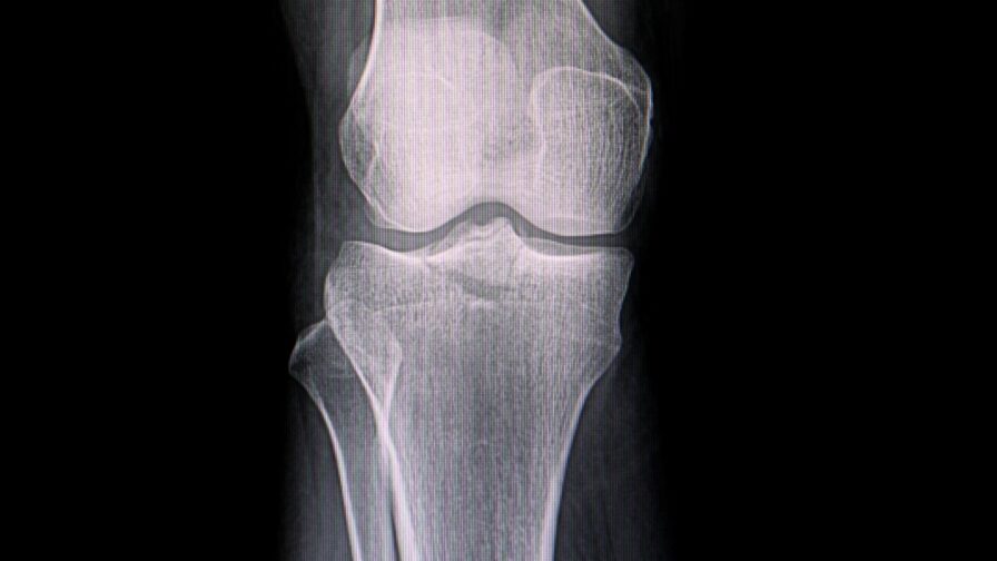 Frattura del piatto tibiale - FisioScience