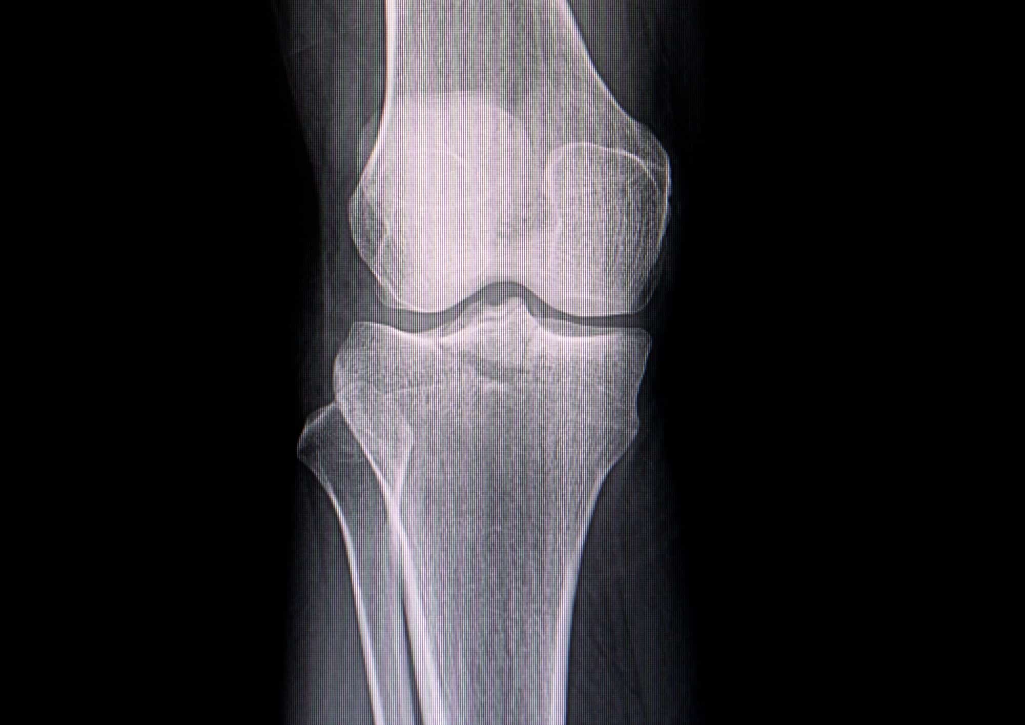 Frattura del piatto tibiale - FisioScience
