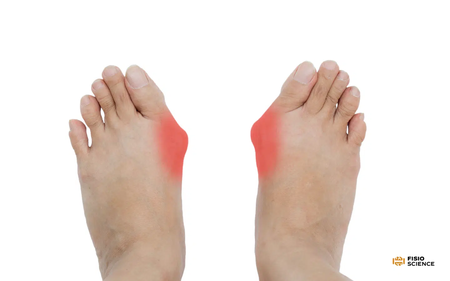 Alluce valgo - FisioScience
