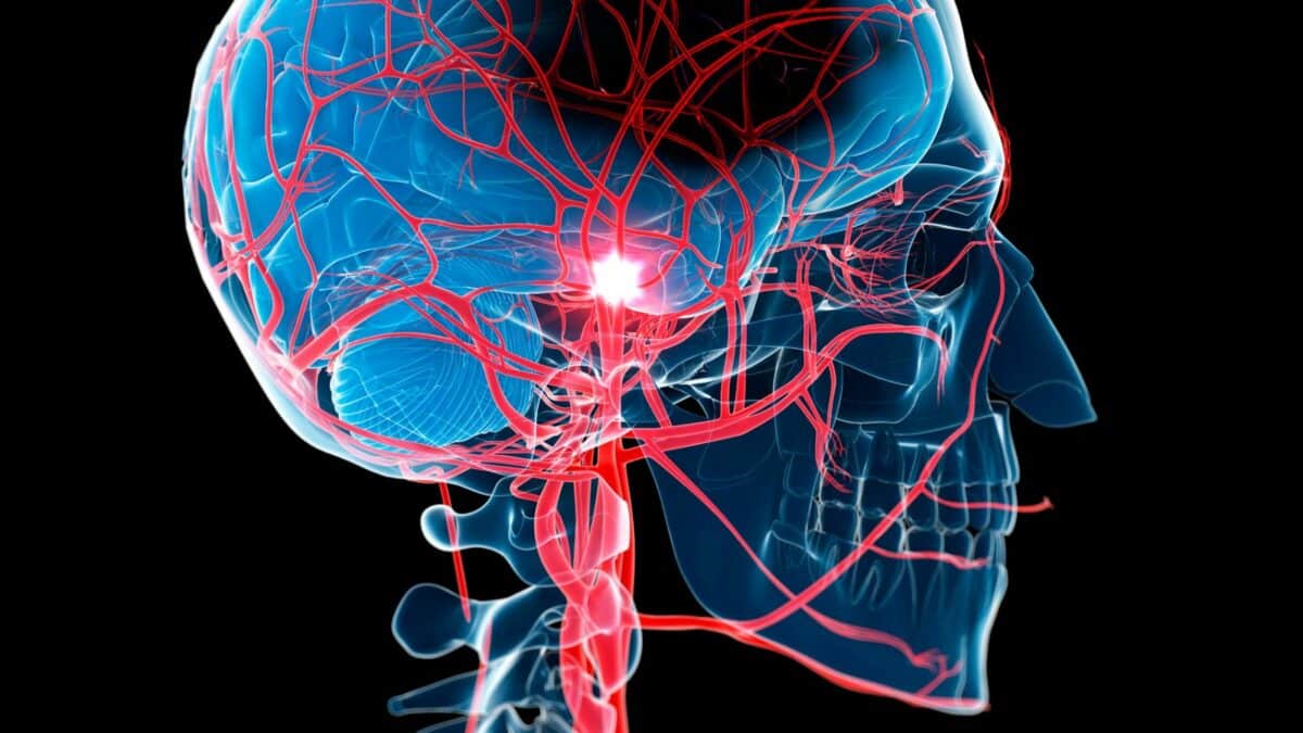 Cervical Artery Dissection CAD - FisioScience