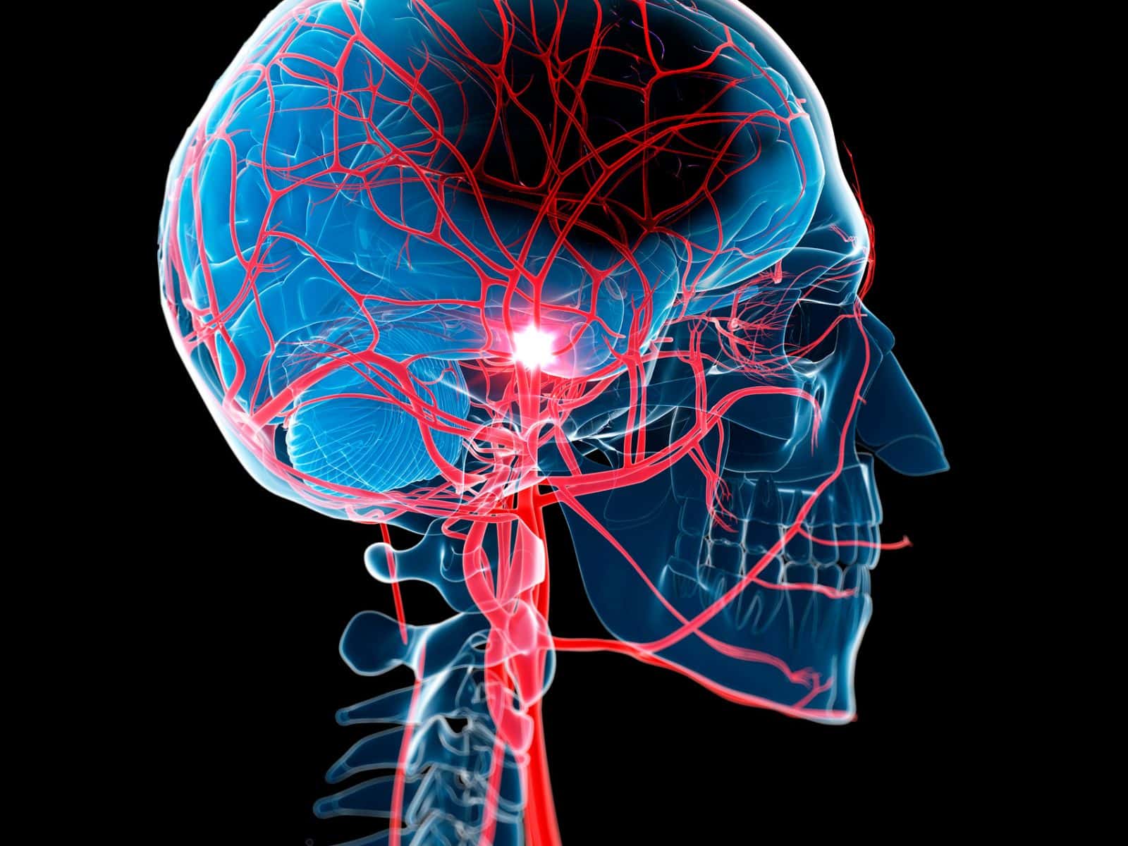 Cervical Artery Dissection CAD - FisioScience
