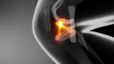 Lesione del Legamento Crociato Posteriore (LCP) - FisioScience