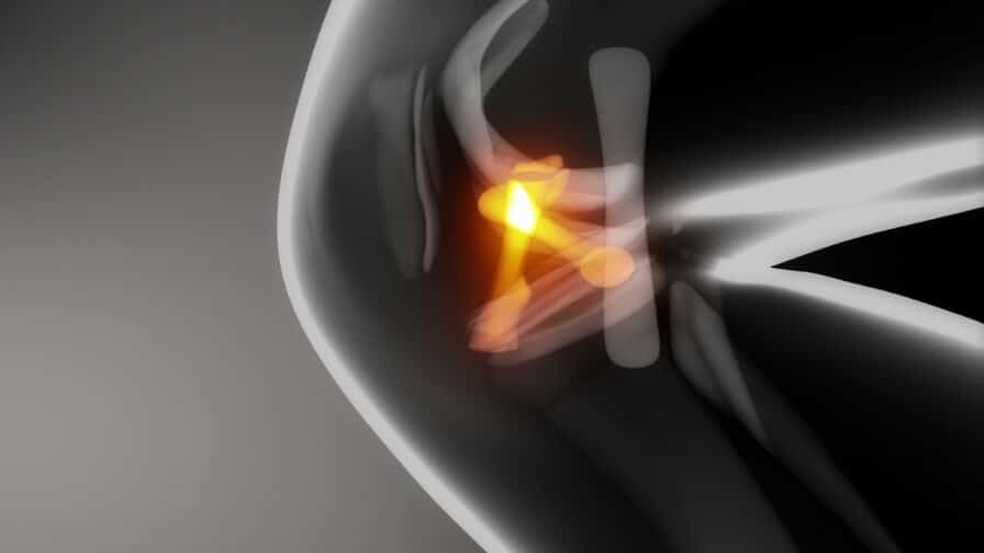 Lesione del Legamento Crociato Posteriore (LCP) - FisioScience