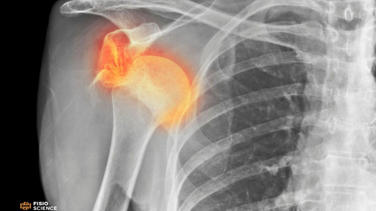 Lussazione di spalla - FisioScience