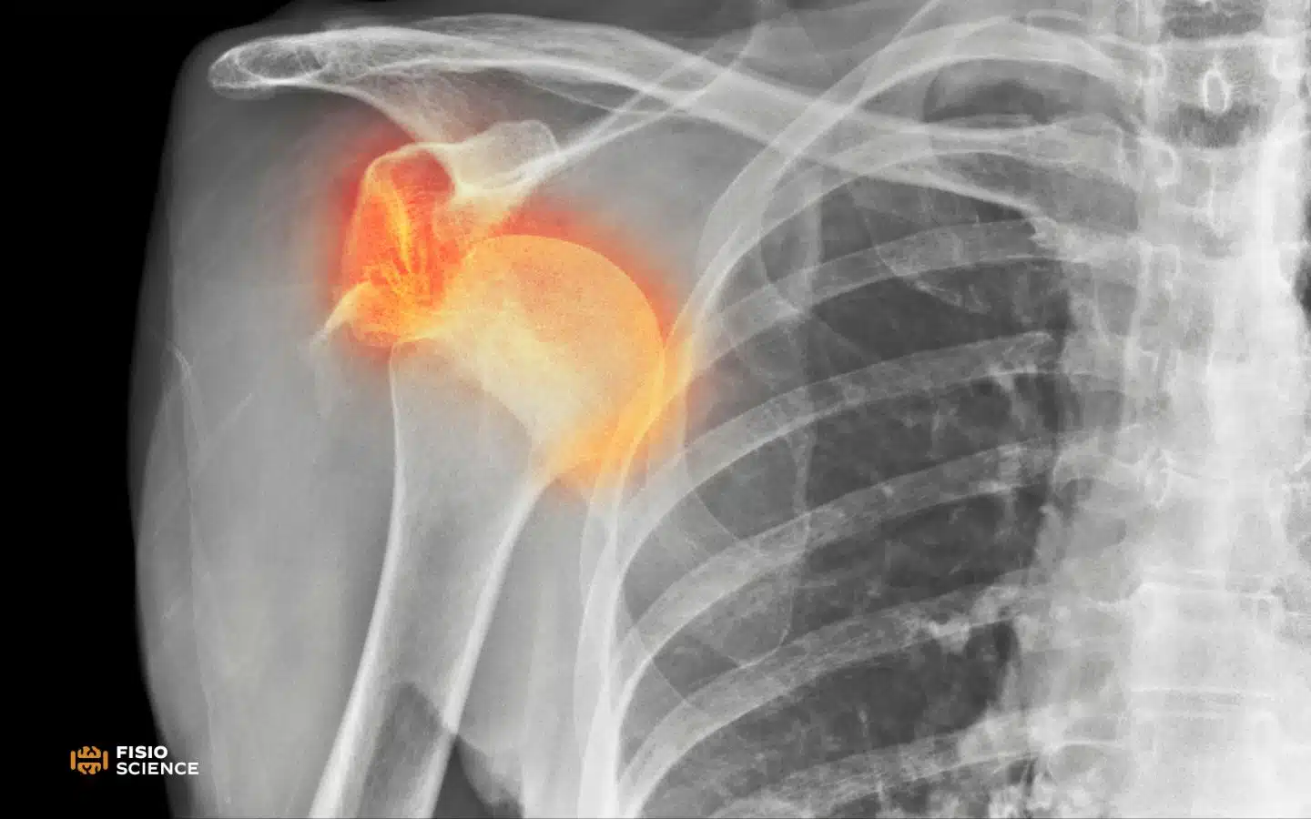 Lussazione di spalla - FisioScience